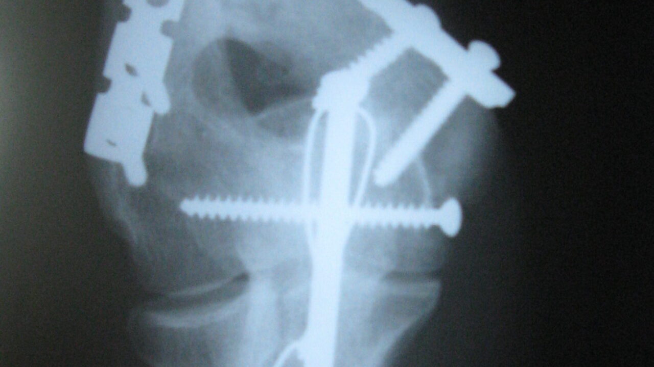 PostTraumatic Malunion, Non-union Treatment | Trishla Ortho