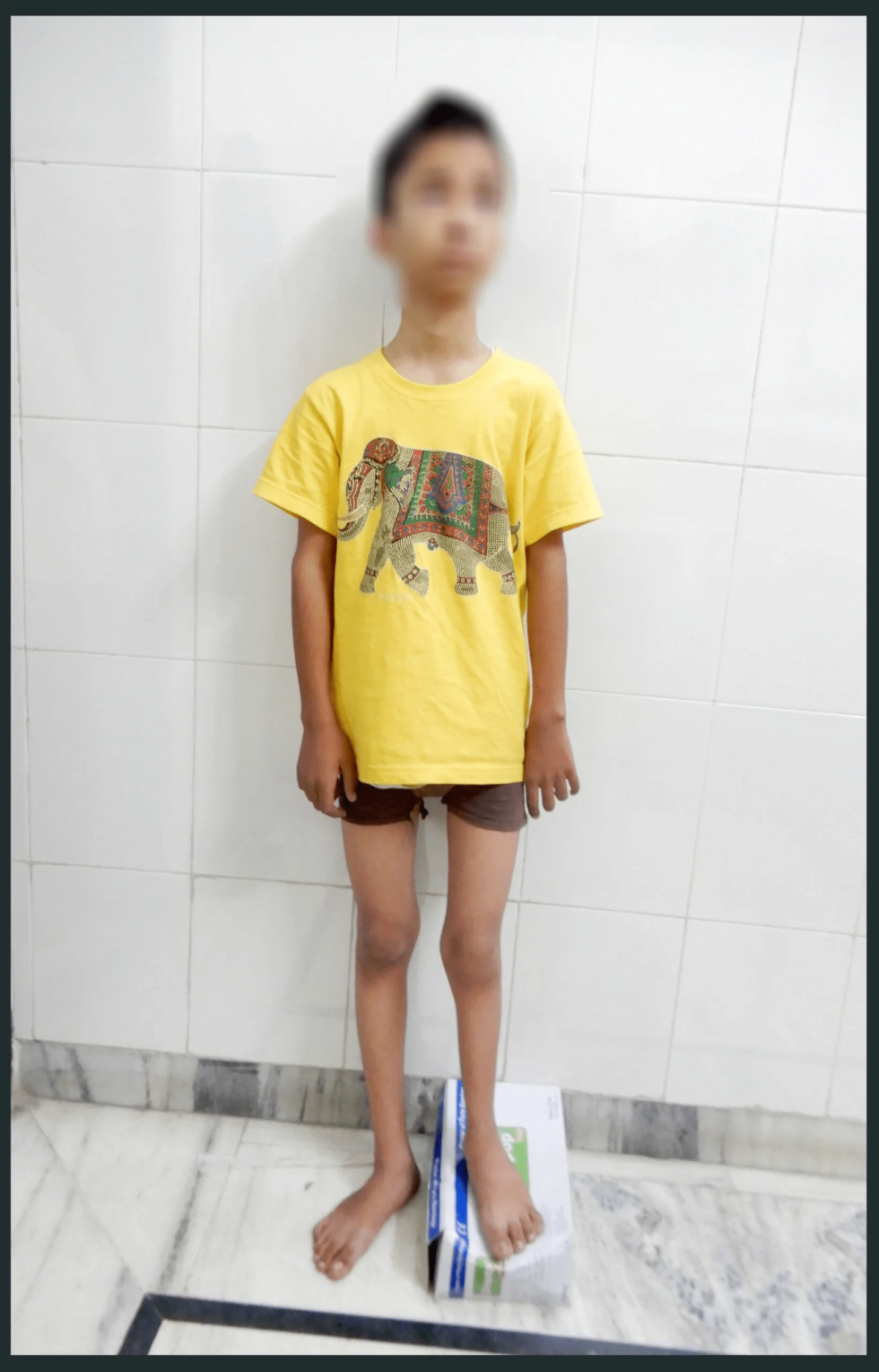 Limb Lengthening & Shortening Surgery in India | Trishla Ortho