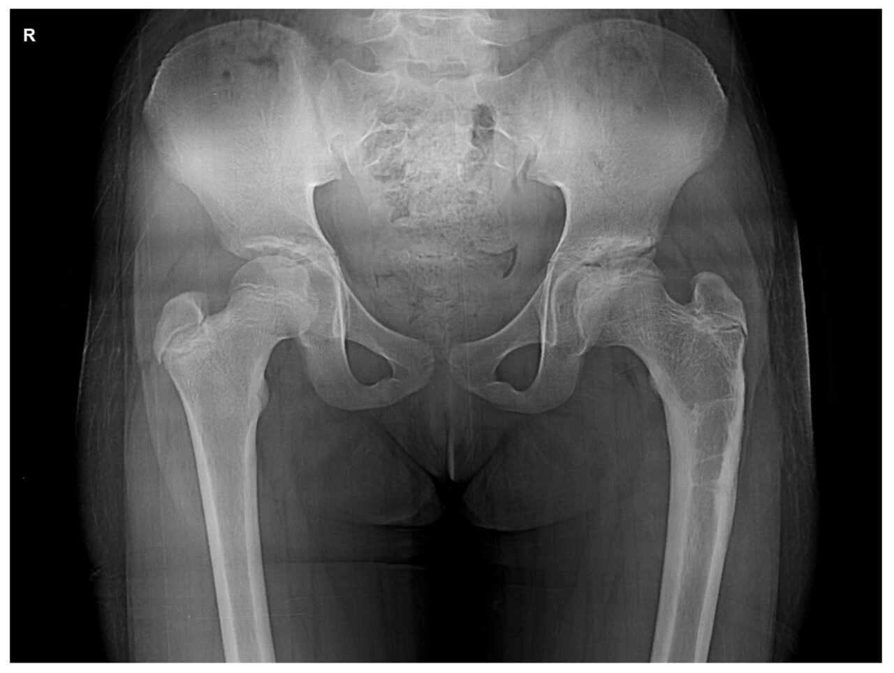 Perthes Disease Treatment (Legg-Calve) in Children – Symptoms & Causes ...